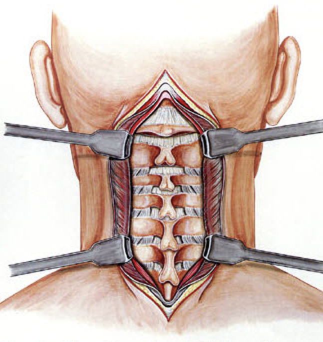 What Is Minimally Invasive Posterior Cervical Fusion Mis Pcf